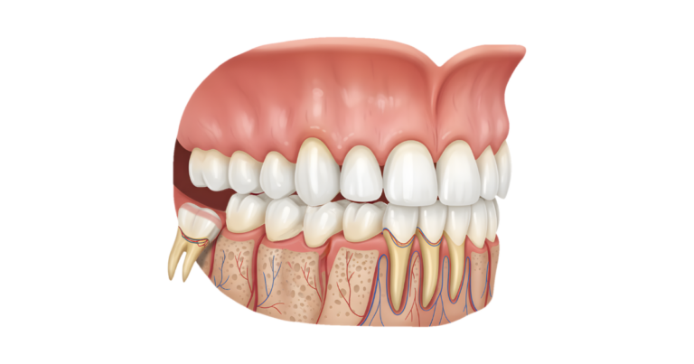 When Can I Sleep on My Side After Tooth Extraction: Answers for a ...