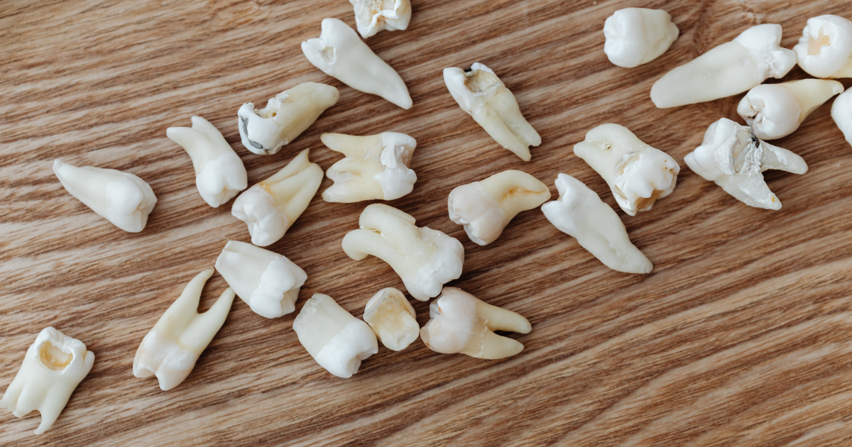 When to Eat After Tooth Extraction Safely for Comfort and Healing ...